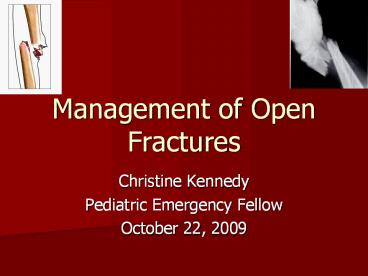Management of Open Fractures presentation | free to download