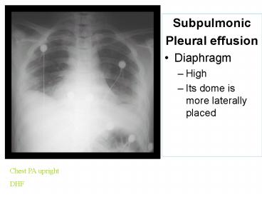 PPT – Subpulmonic PowerPoint presentation | free to download - id ...