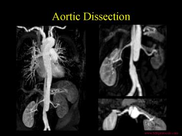 Aortic Dissection presentation | free to download