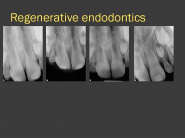Regenerative endodontics presentation | free to download