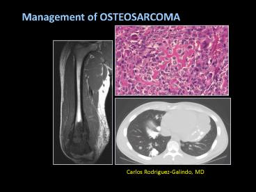 Management of OSTEOSARCOMA presentation | free to view