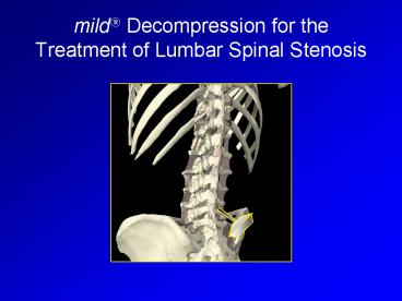 mild? Decompression for the Treatment of Lumbar Spinal Stenosis ...