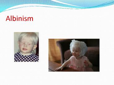 Albinism presentation | free to view