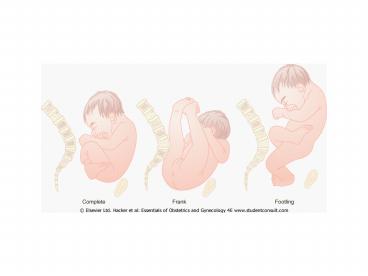 Partial breech extraction. A, After spontaneous delivery to the ...
