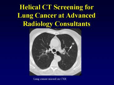 Helical CT Screening for Lung Cancer at Advanced Radiology Consultants ...