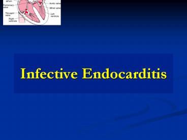 Infective Endocarditis presentation | free to download