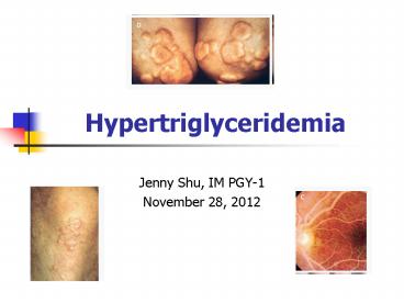 Hypertriglyceridemia presentation | free to view