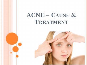 Acne - Cause and Treatment presentation | free to download