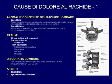 CAUSE DI DOLORE AL RACHIDE - 1 presentation | free to view