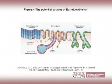 PPT – Figure 4 The potential sources of Barrett epithelium PowerPoint ...