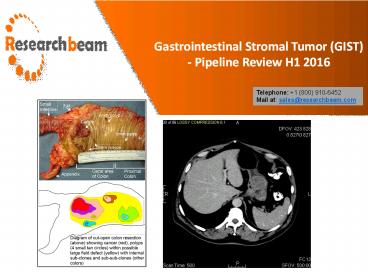 Gastrointestinal Stromal Tumors Diagnosis and Treatment presentation ...