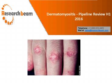 Dermatomyositis Causes and Symptoms – Overview presentation | free to ...