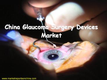 PPT – China Glaucoma Surgery Devices Market PowerPoint presentation ...
