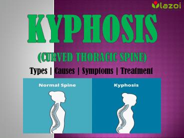 Kyphosis: Curved Thoracic Spine presentation | free to download
