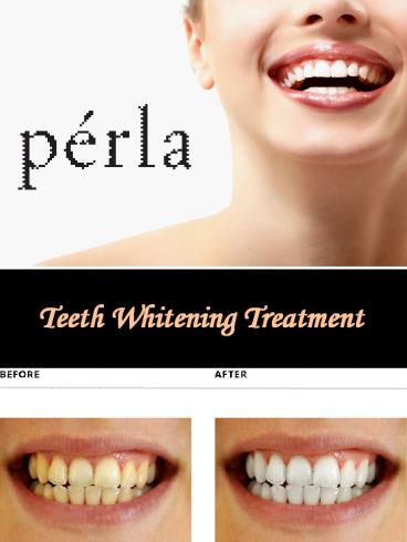 PPT – Teeth Whitening Treatment PowerPoint presentation | free to ...
