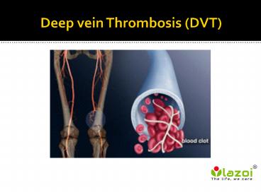 Deep vein Thrombosis (DVT) presentation | free to download