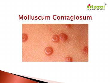 Molluscum Contagiosum: Symptoms, Causes, Diagnosis, Treatment and ...
