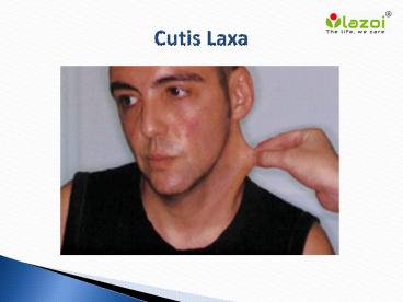 Cutis Laxa: Causes, Symptoms, Diagnosis and Treatment presentation ...