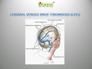 PPT – Cerebral Venous Sinus Thrombosis (CVST) PowerPoint presentation ...