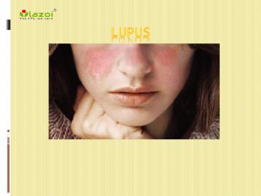 Lupus: Symptoms, Causes, Diagnosis and Treatment presentation | free to ...