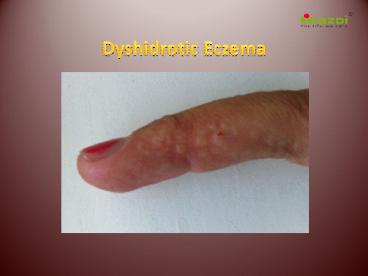 PPT – Dyshidrotic Eczema: Symptoms, Causes, Diagnosis and Treatment ...