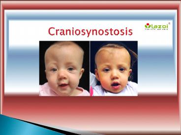 Craniosynostosis: Types, Causes, Symptoms, Diagnosis and Treatment ...