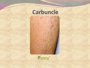 Carbuncle: Causes, Symptoms, Diagnosis, Treatment and Prevention ...