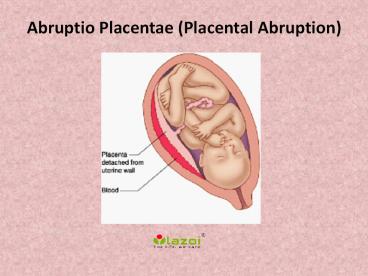 Abruptio Placentae (Placental Abruption): Overview of symptoms, causes and treatment ...