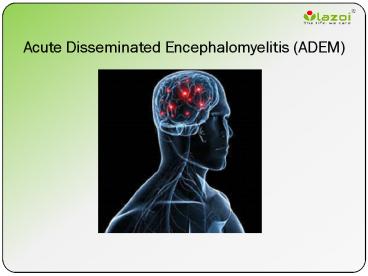 Acute disseminated encephalomyelitis (ADEM): Symptoms, causes ...