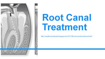 Root Canal Treatment presentation | free to download