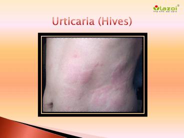 Urticaria (Hives): Symptoms, Causes, Diagnosis and Treatment ...