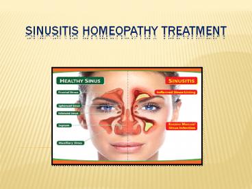 Sinusitis Homeopathy Treatment 10 oct 17 presentation | free to download