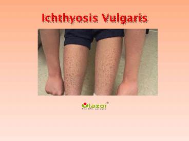 Ichthyosis Vulgaris: Symptoms, Causes, Diagnosis and Treatment ...