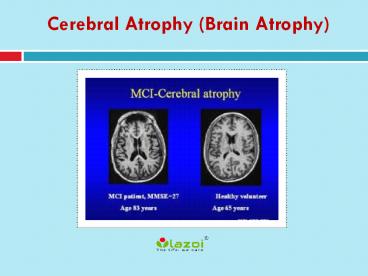 Cerebral Atrophy (Brain Atrophy): Learn about symptoms, causes and ...
