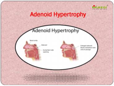 Adenoid hypertrophy Causes, Symptoms, Diagnosis, Prevention Treatment ...