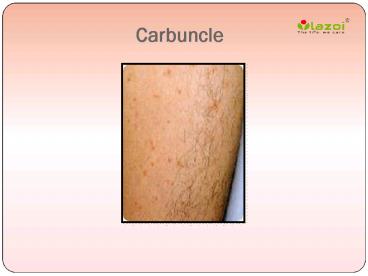 Carbuncle: Causes, Symptoms, Diagnosis, Treatment and Prevention (1 ...