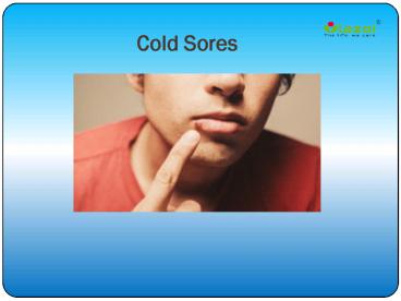 Cold Sores: Symptoms, Causes, Diagnosis and Treatment (1) presentation ...