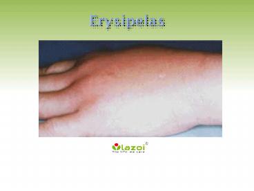 PPT – Erysipelas: Symptoms, Causes, Diagnosis and Treatment (1 ...