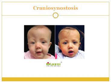 Craniosynostosis: Types, Causes, Symptoms, Diagnosis and Treatment (1 ...