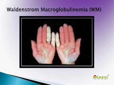 Waldenstrom macroglobulinemia: An overview of symptoms, diagnosis and ...