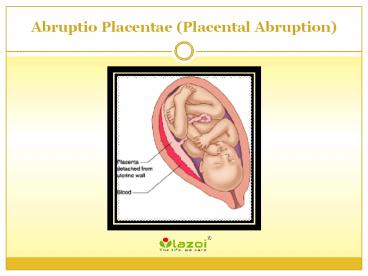 Abruptio Placentae (Placental Abruption): Overview of symptoms, causes ...