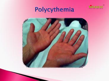 Polycythemia: Causes, Symptoms and Treatment (1) presentation | free to ...
