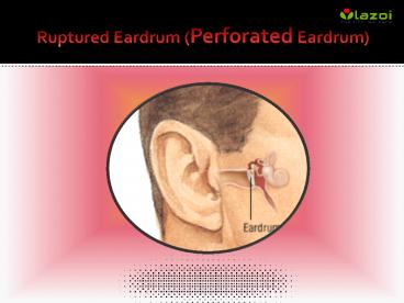 Ruptured Eardrum (Perforated Eardrum): A sneak peek (1) presentation ...