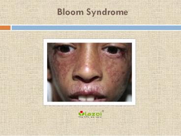 Bloom Syndrome presentation | free to download