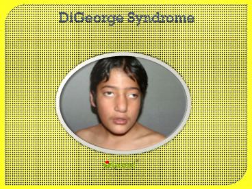 DiGeorge Syndrome presentation | free to download