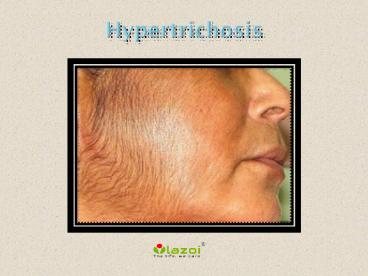Hypertrichosis presentation | free to download