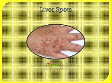 PPT – Liver Spots : Causes, Symptoms, Daignosis, Prevention and ...