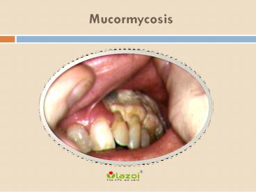 Mucormycosis: Causes, Symptoms, Daignosis, Prevention and Treatment ...