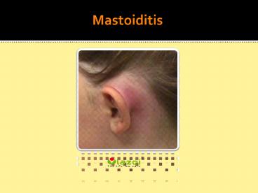 Mastoiditis: Causes, Symptoms, Daignosis, Prevention and Treatment ...