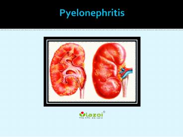 Pyelonephritis: Causes, Symptoms, Daignosis, Prevention and Treatment ...